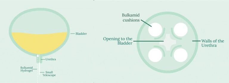 Bulkamid | Griffin Health