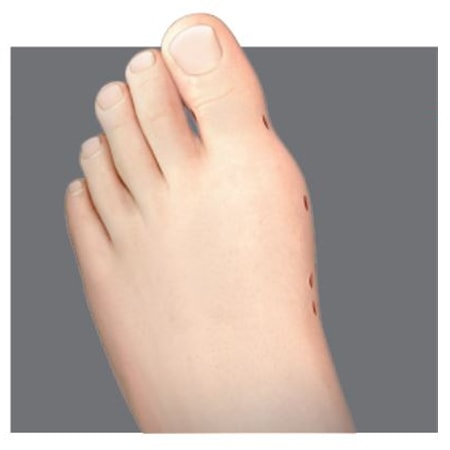 Minimally Invasive Bunion Surgery in Derby, Connecticut