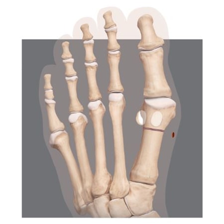 Minimally Invasive Bunion Surgery in Derby, Connecticut