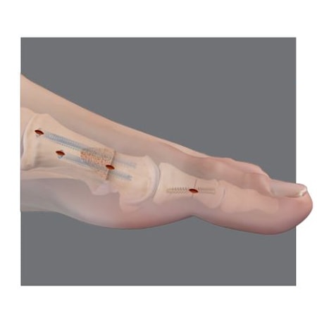 Minimally Invasive Bunion Surgery in Derby, Connecticut
