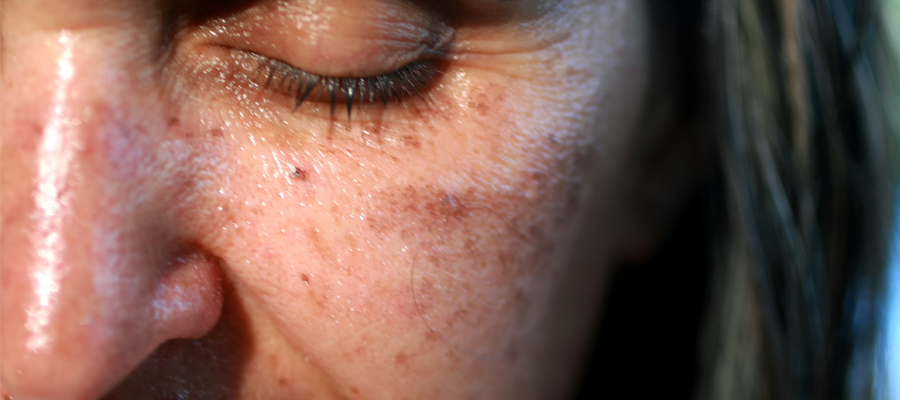 Griffin Hospital Offers Free Facial Skin Screenings | Griffin Health