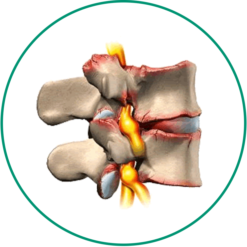 Minimally-Invasive Lower Back Surgery | Griffin Health